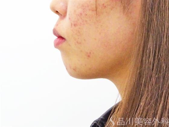 プチアゴ修整(クレヴィエル2cc注入)の施術前／施術直後♪ 担当医：吉永 裕臣 スキンクリニック神戸院 | 品川美容外科 症例サイト